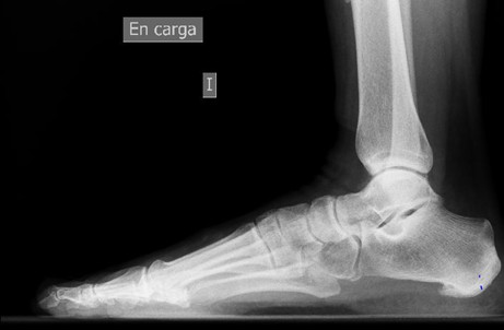 Espolón calcáreo - Clínica Podológica Virgen del Espino